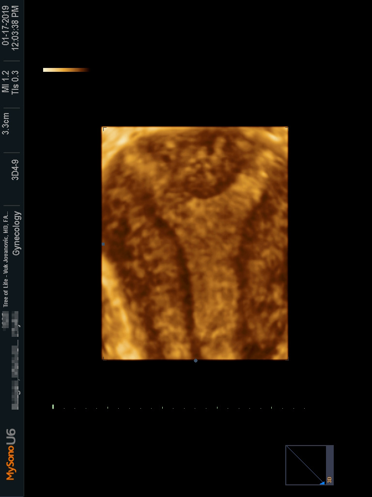 Uterine Septum, What it is, Diagnosis and Treatment - Tree of Life Center