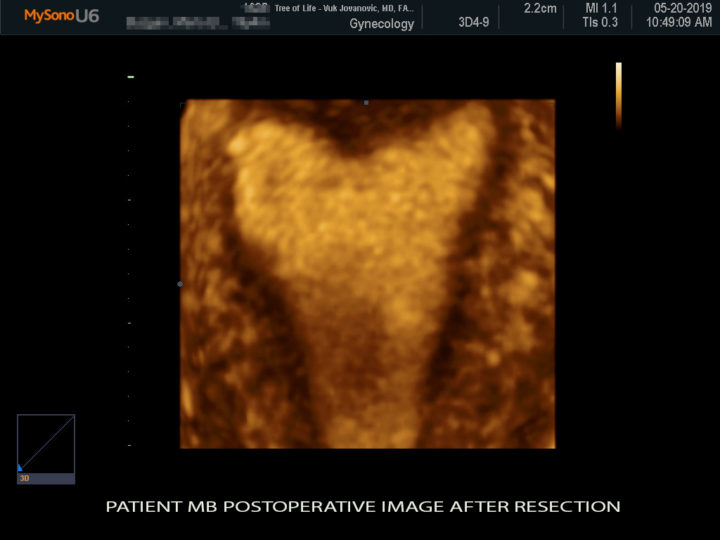 Uterine Septum, What it is, Diagnosis and Treatment - Tree of Life Center